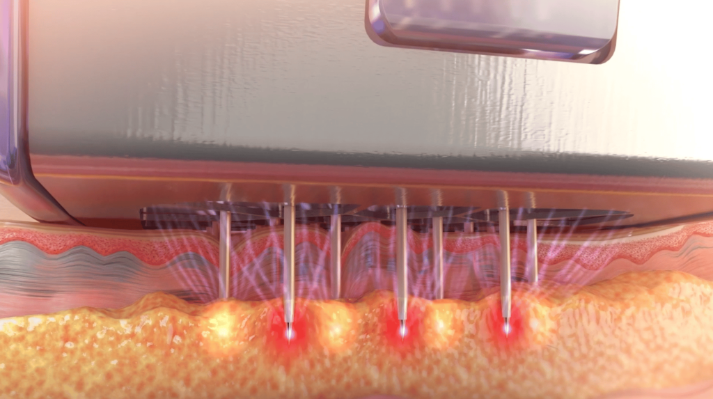 Radiofrecuencia fraccionada - Clínca LM